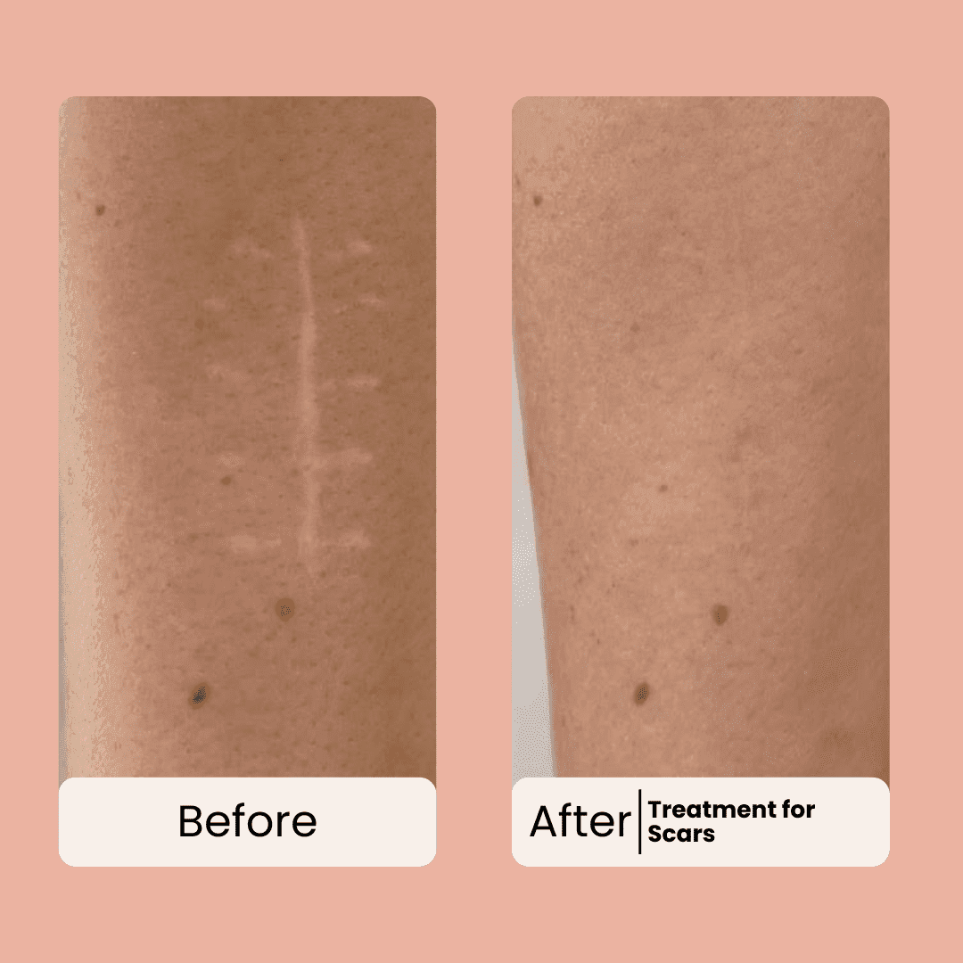How to Remove Scars from Face Permanently – Proven Treatments That Work
