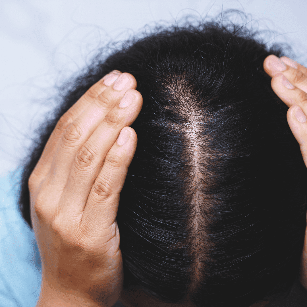 GFC Hair Treatment for Severe Hair Fall & Weak Roots